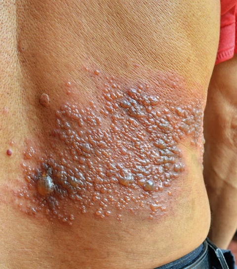 Herpes Zóster (Culebrilla): cómo tratar esta dolorosa enfermedad ...